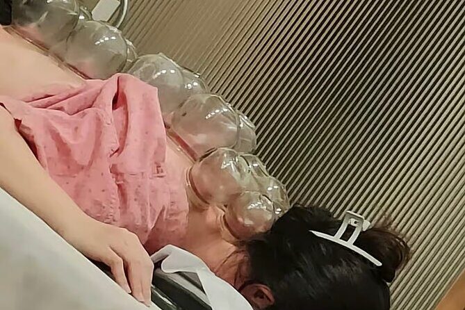 Acupuncture and Suction Cups Session at the Hospital - An In-Depth Look at the Experience