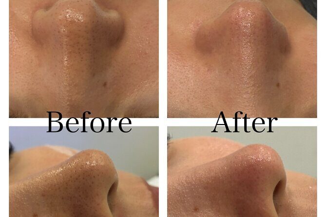 HydraFacial and Dry Head Spa Treatment in Shibuya - FAQs