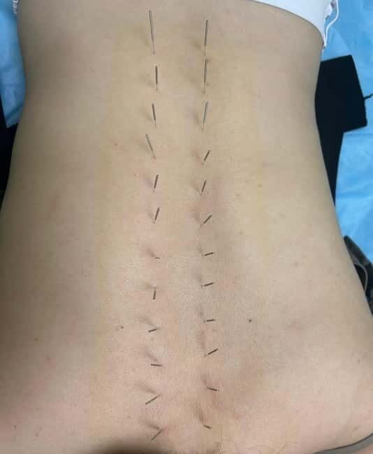 Shanghai: Chinese Medicine Acupuncture and Cupping Session - Who Should Consider This Tour?