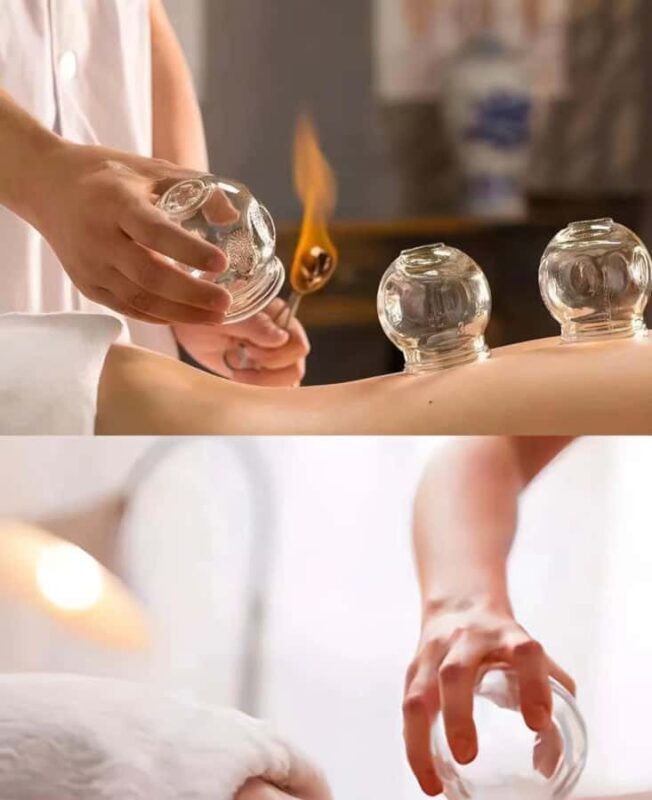Traditional Chinese Medicine AcupunctureCupping Experience - Key Points